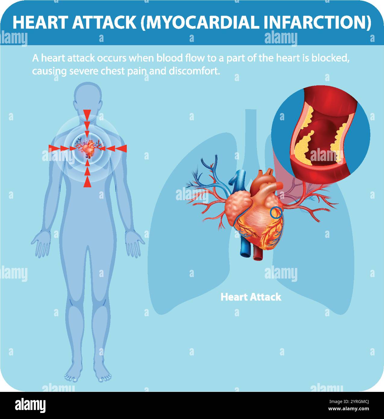 Illustration of heart attack causes and symptoms Stock Vector Image ...