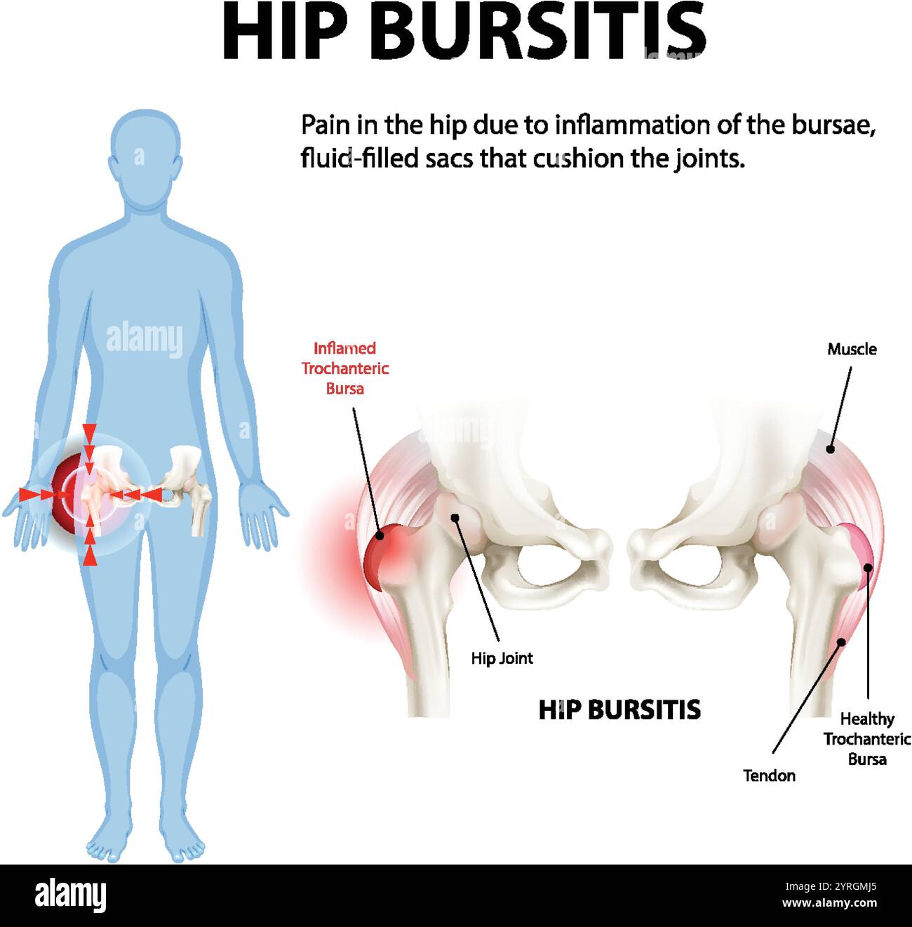 Illustration of hip bursitis and joint inflammation Stock Vector Image & Art - Alamy