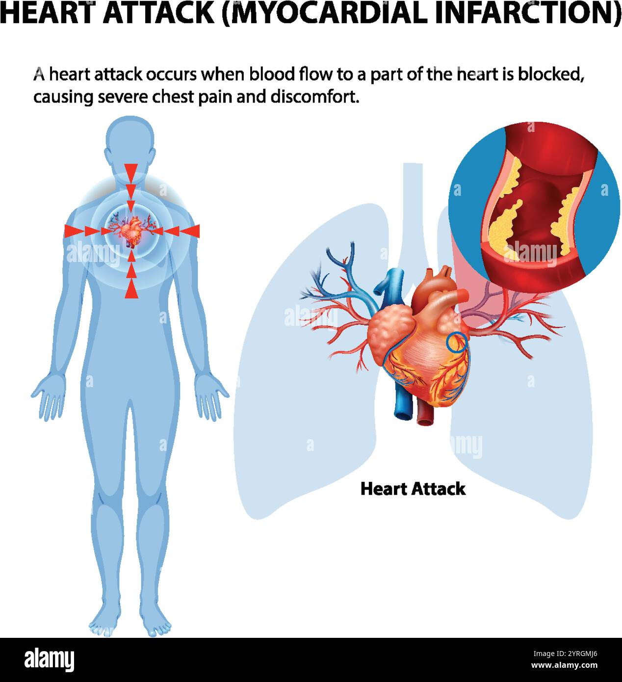 Illustration of heart attack symptoms and causes Stock Vector Image & Art - Alamy