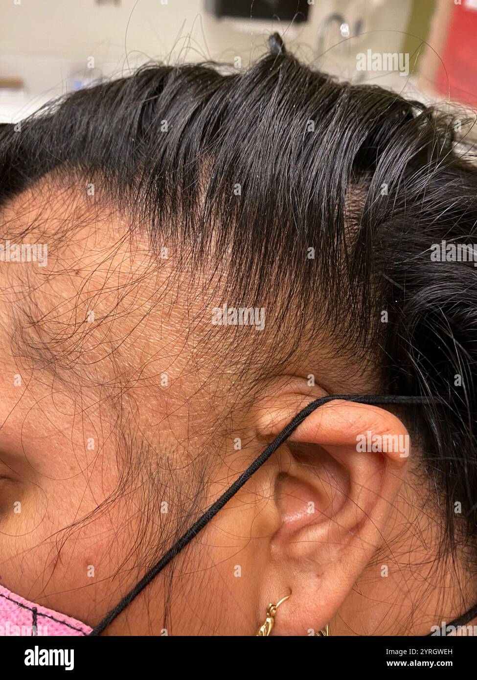 Scalp of a patient with female pattern hair loss, also known as female ...