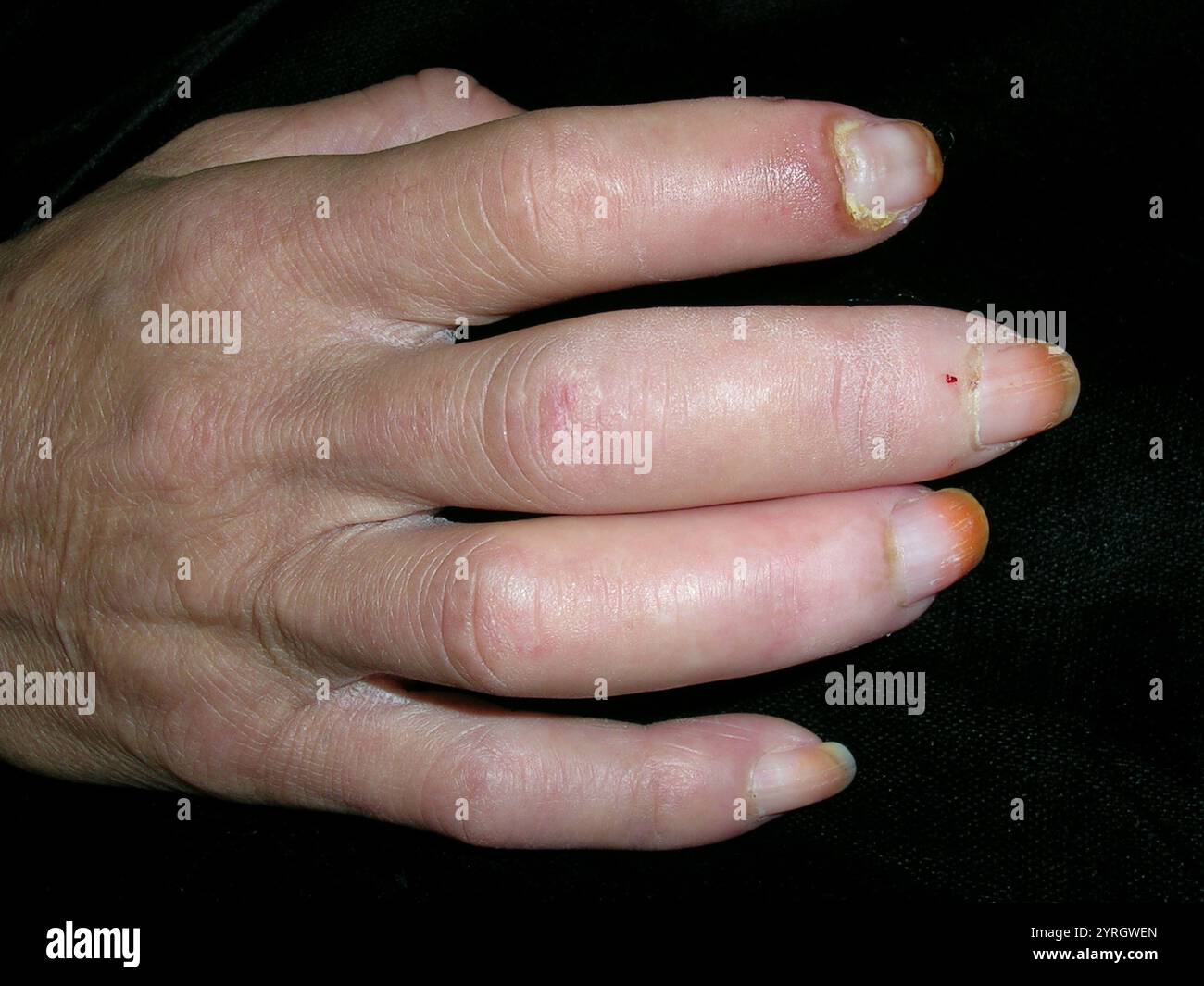 Scleroderma causing severe swelling (dactylitis) of the fingers of a 50 ...