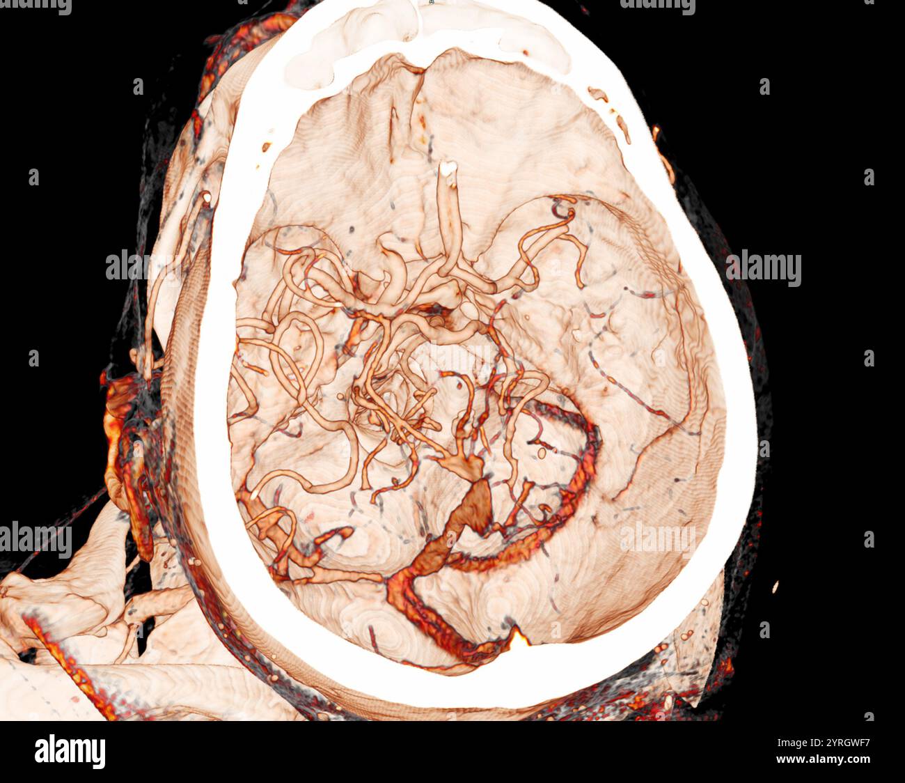 Magnetic resonance imaging (MRI) angiogram of an axial section through ...