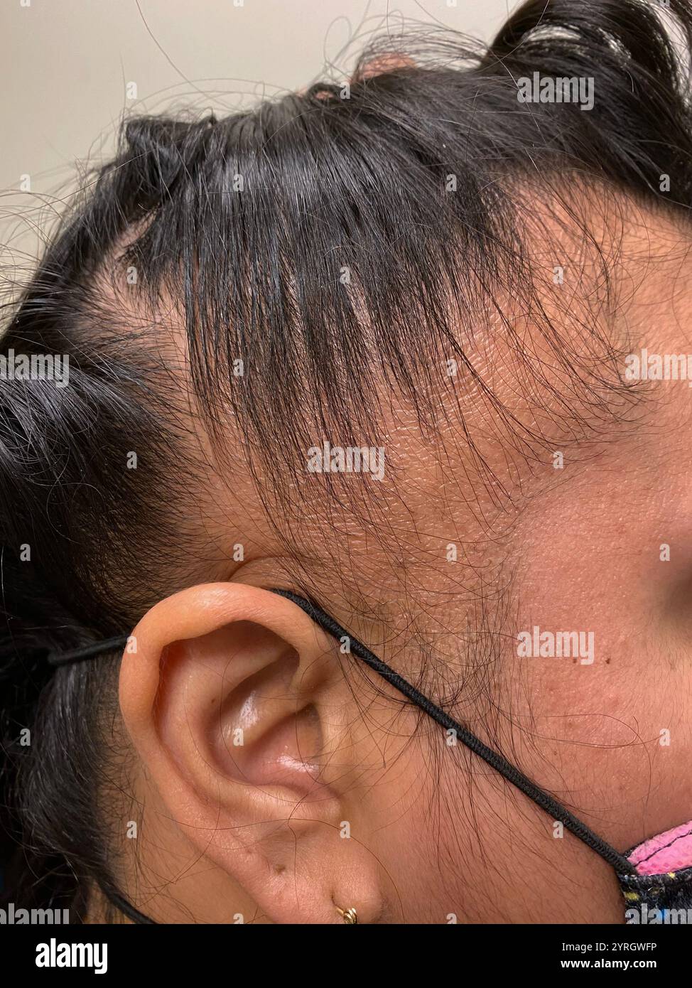 Scalp of a patient with female pattern hair loss, also known as female ...