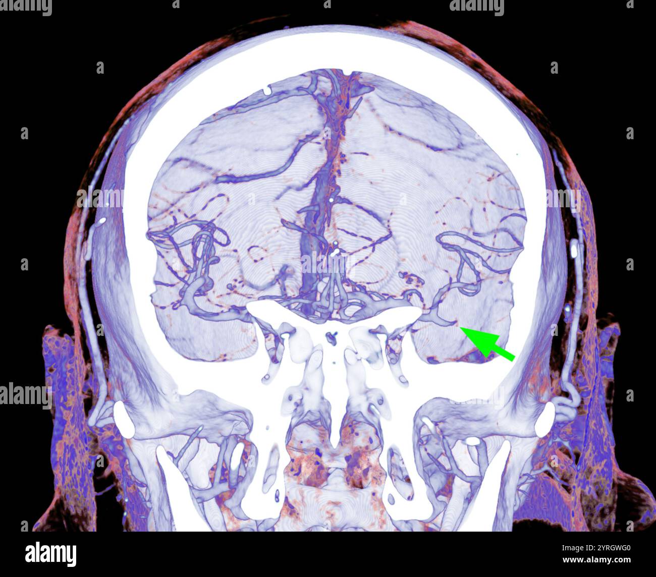 Magnetic resonance imaging (MRI) angiogram of a coronal section through ...