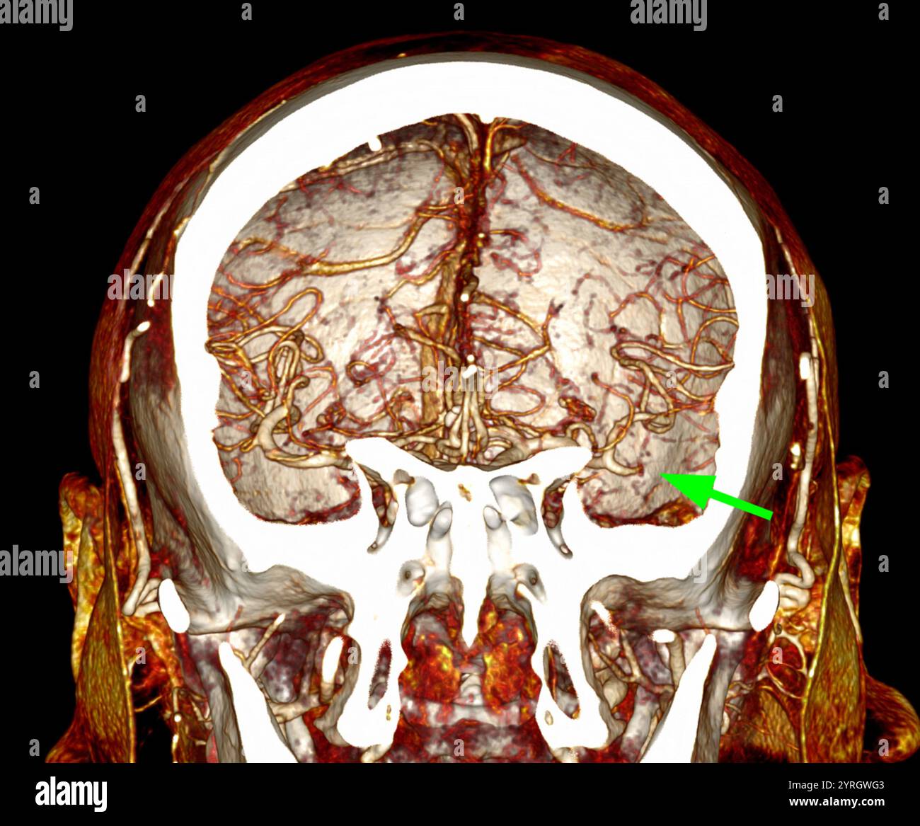 Magnetic resonance imaging (MRI) angiogram of a coronal section through the brain, revealing ...
