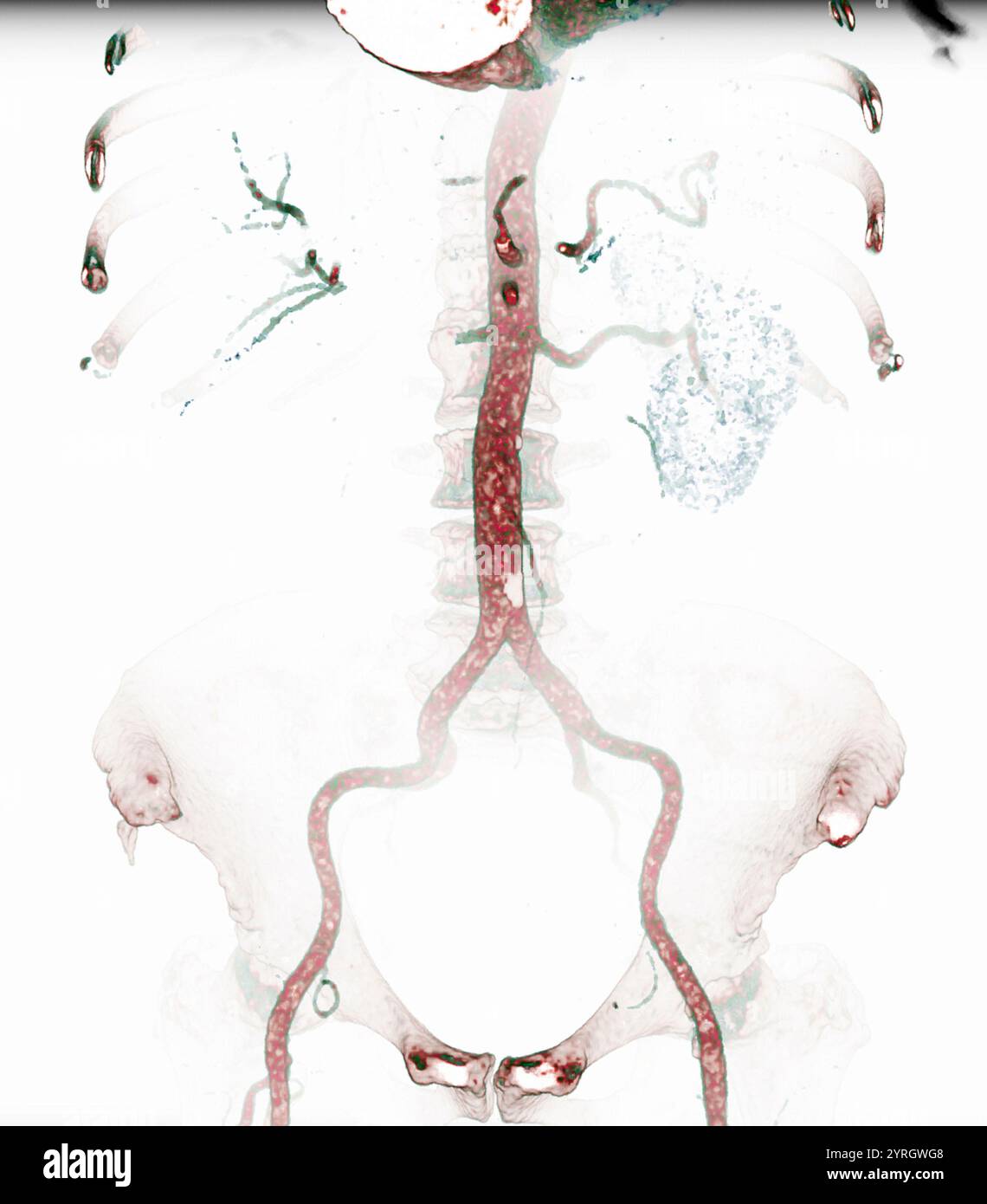 Coloured computed tomography (CT) coronal scan of a patient with a ...