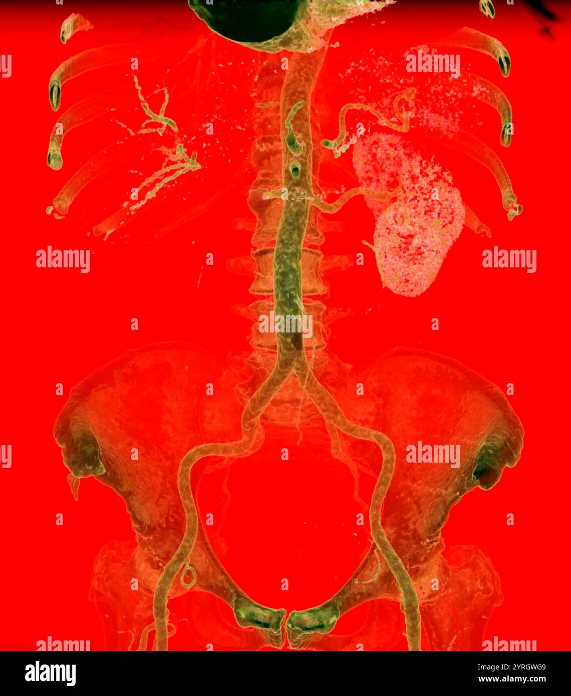 Coloured computed tomography (CT) coronal scan of a patient with a ...