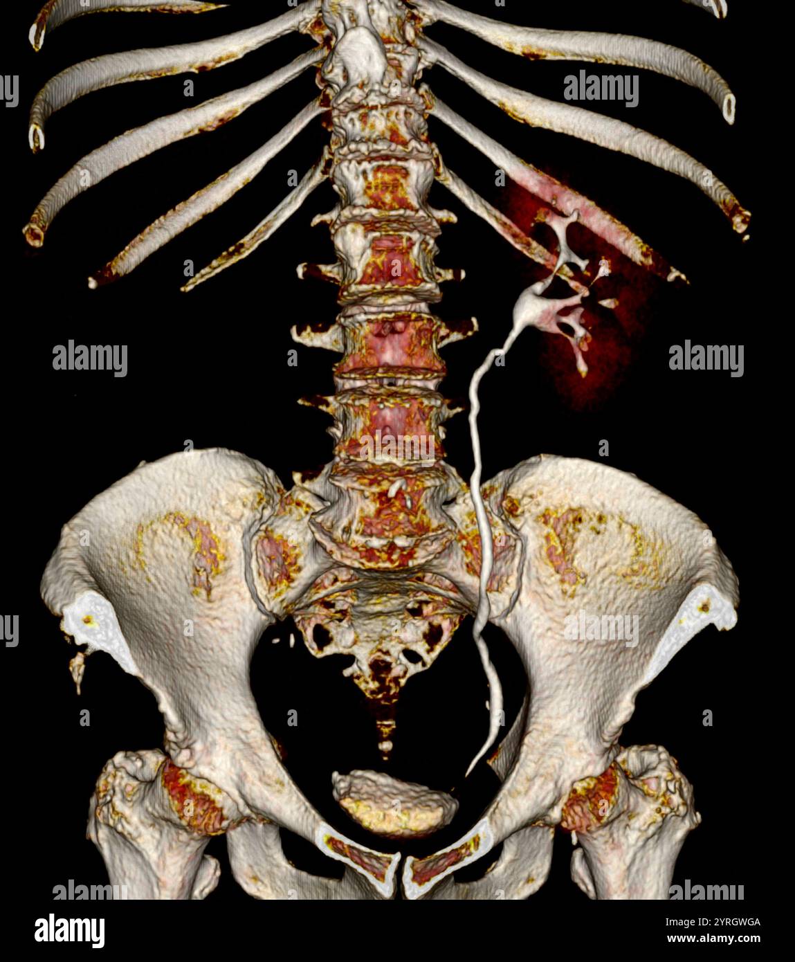 Coloured computed tomography (CT) coronal scan of a patient with a ...