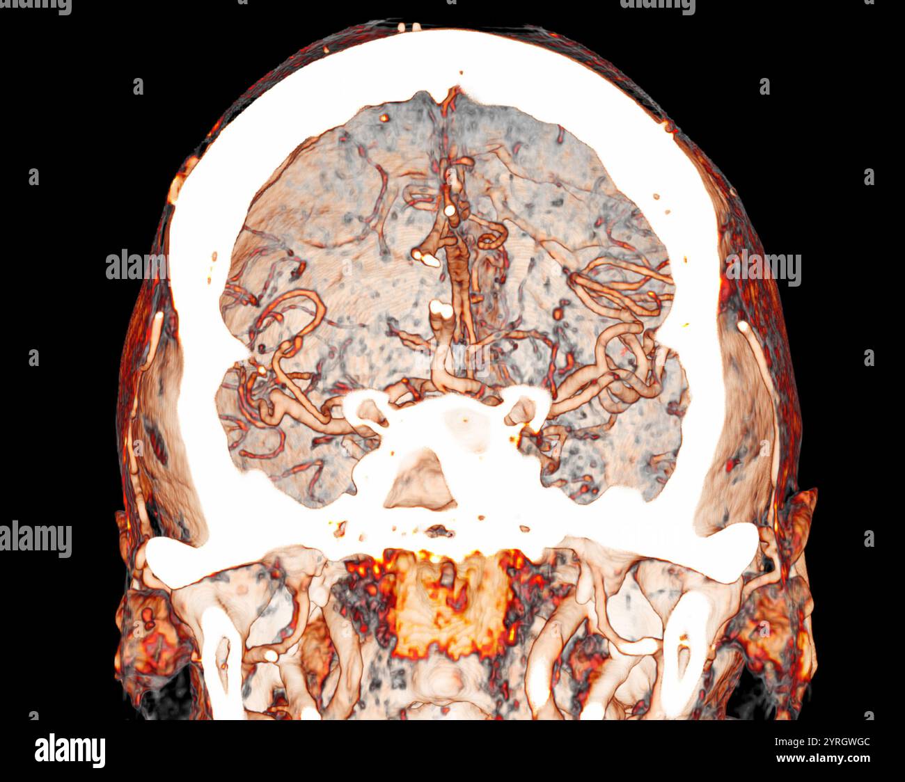 Magnetic resonance imaging (MRI) angiogram of a coronal section through ...