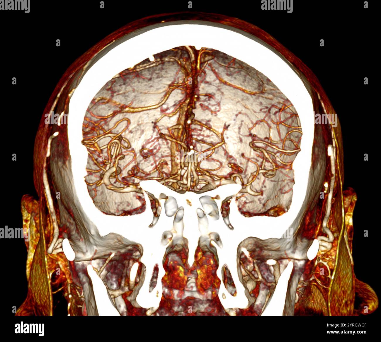Magnetic resonance imaging (MRI) angiogram of a coronal section through ...