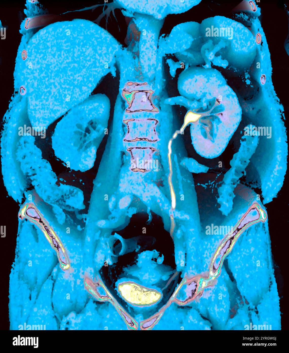 Coloured computed tomography (CT) coronal scan of a patient with a ...