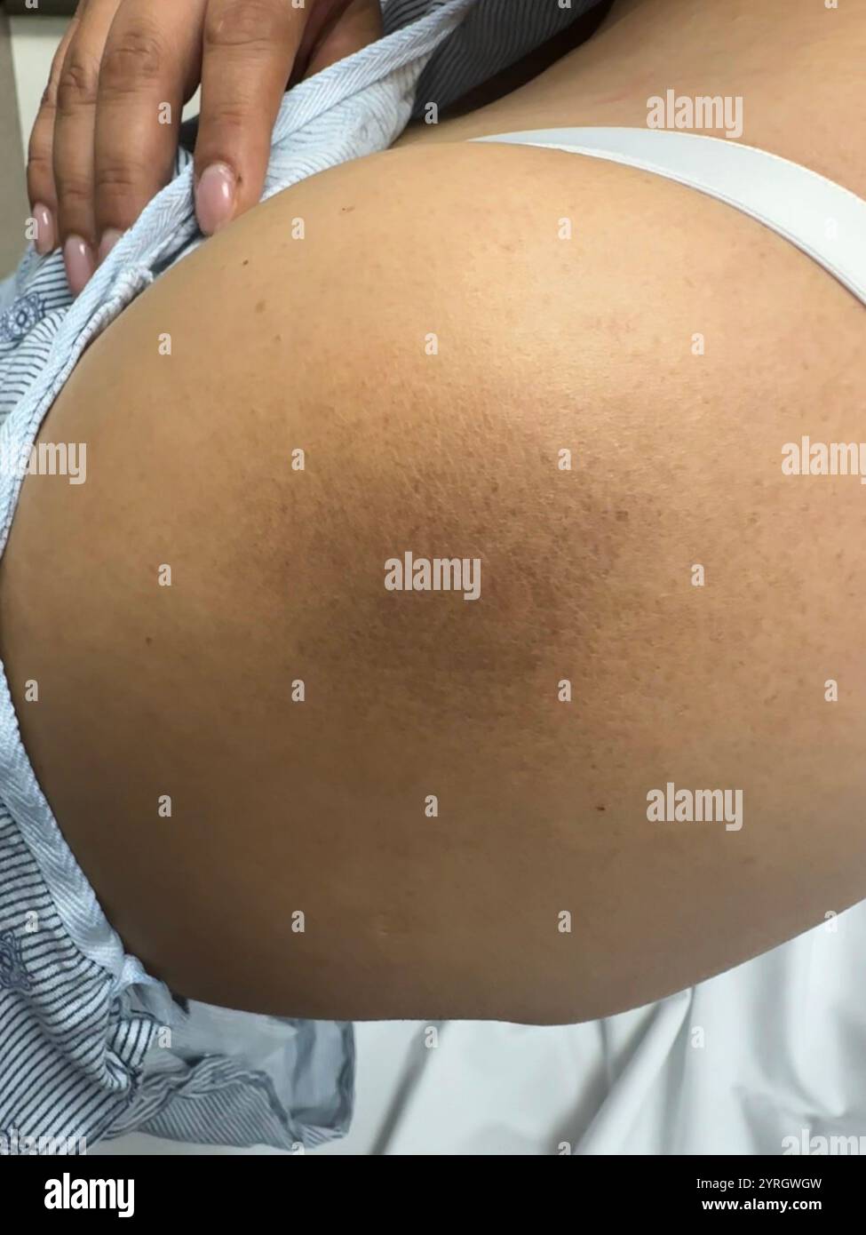 Ashy dermatosis on the shoulder of a Hispanic female patient. This ...