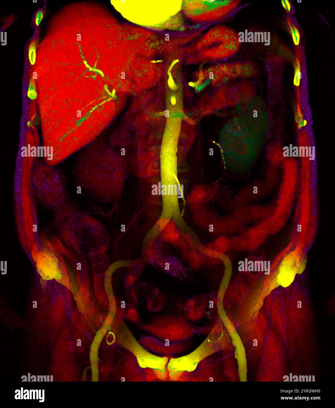 Coloured computed tomography (CT) coronal scan of a patient with a ...
