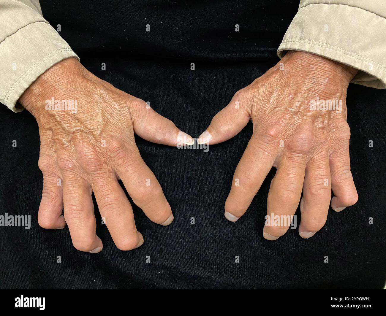 Scleroderma causing severe swelling (dactylitis) of the fingers of a ...