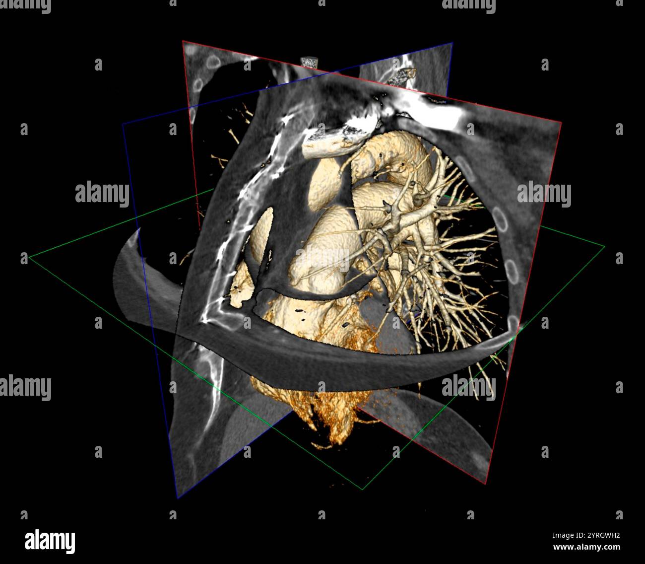 Coloured 3D computed tomography (CT) angiogram scan of the heart reveals atherosclerosis ...