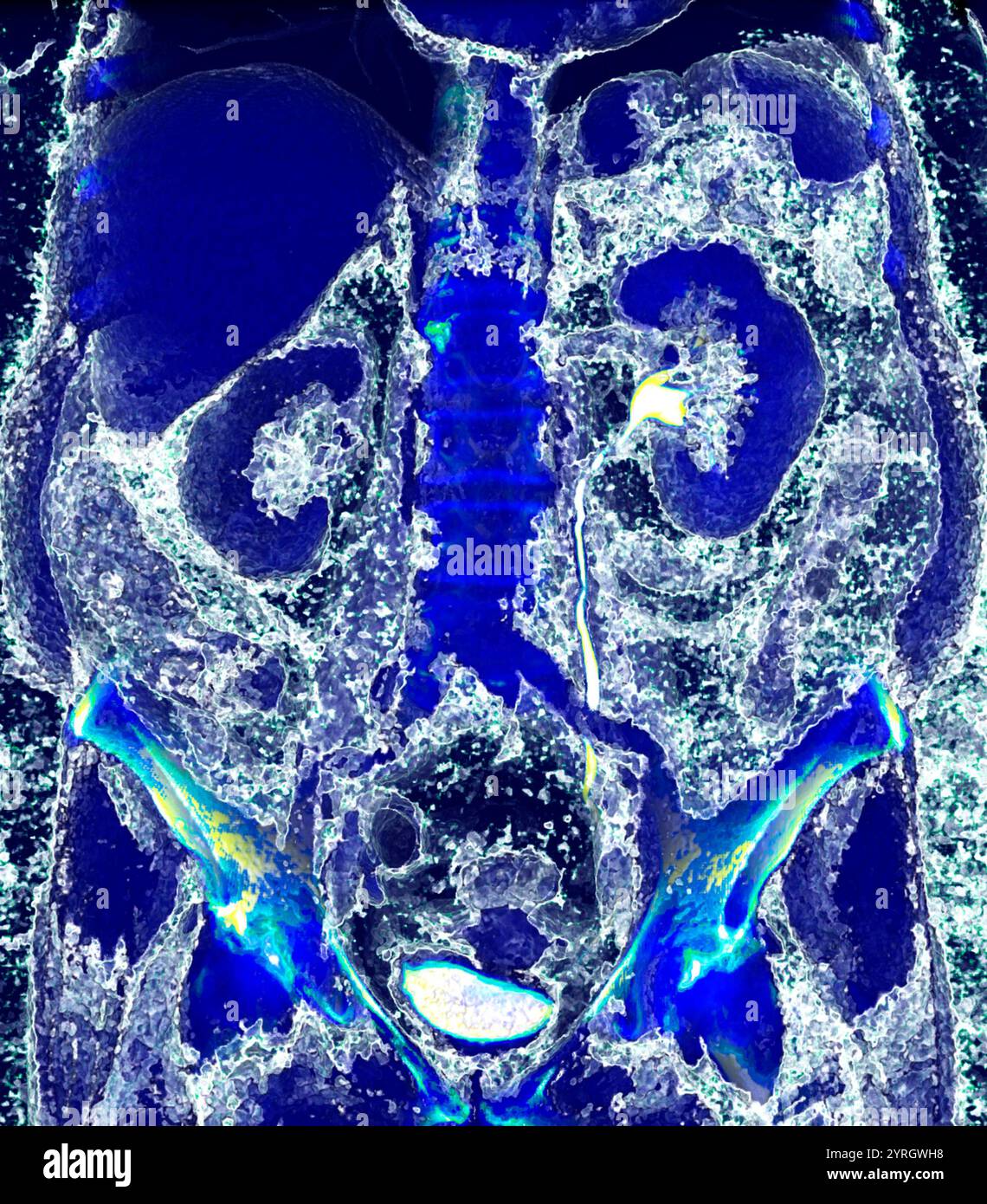 Coloured computed tomography (CT) coronal scan of a patient with a ...