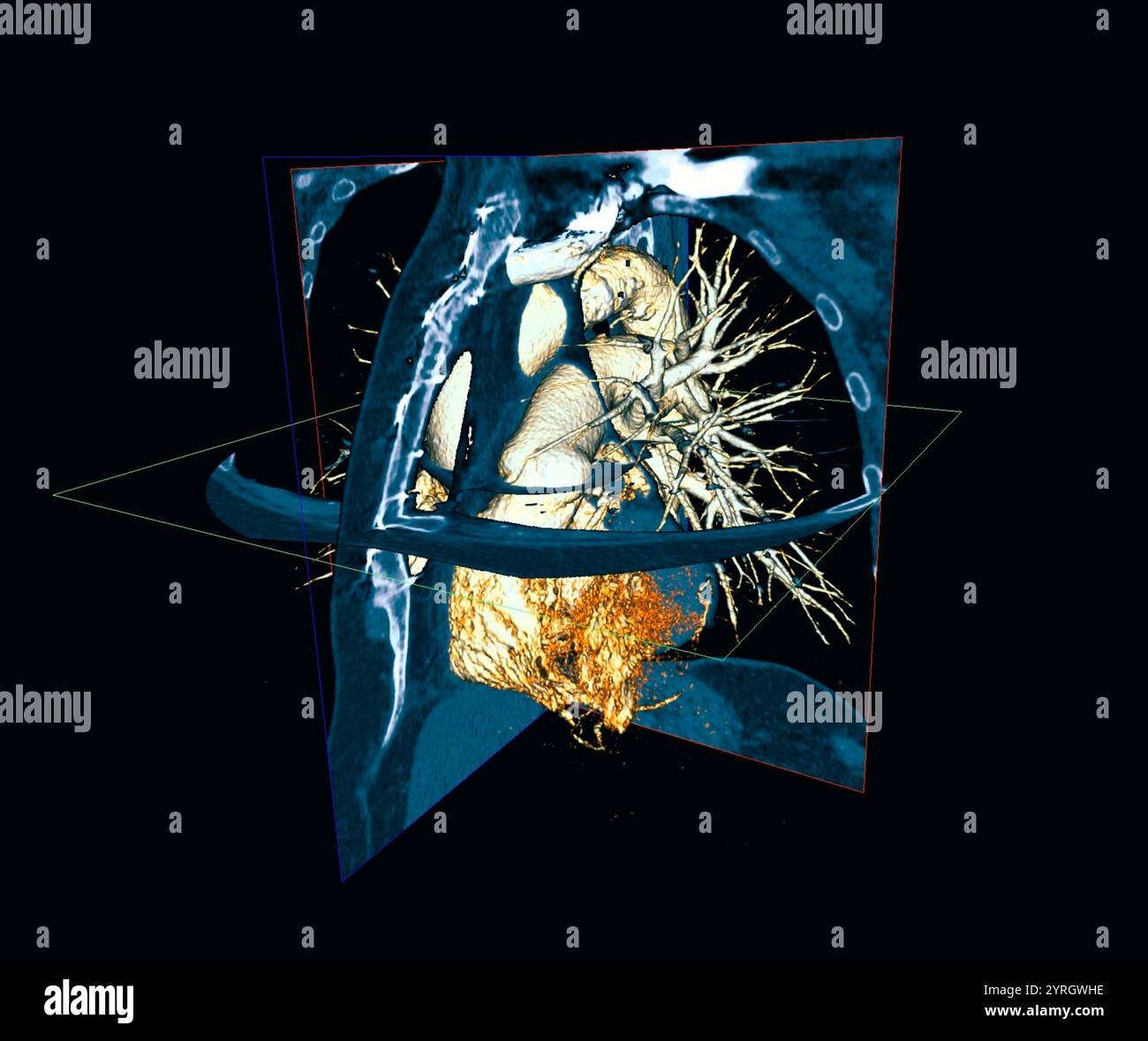 Coloured 3D computed tomography (CT) angiogram scan of the heart reveals atherosclerosis ...