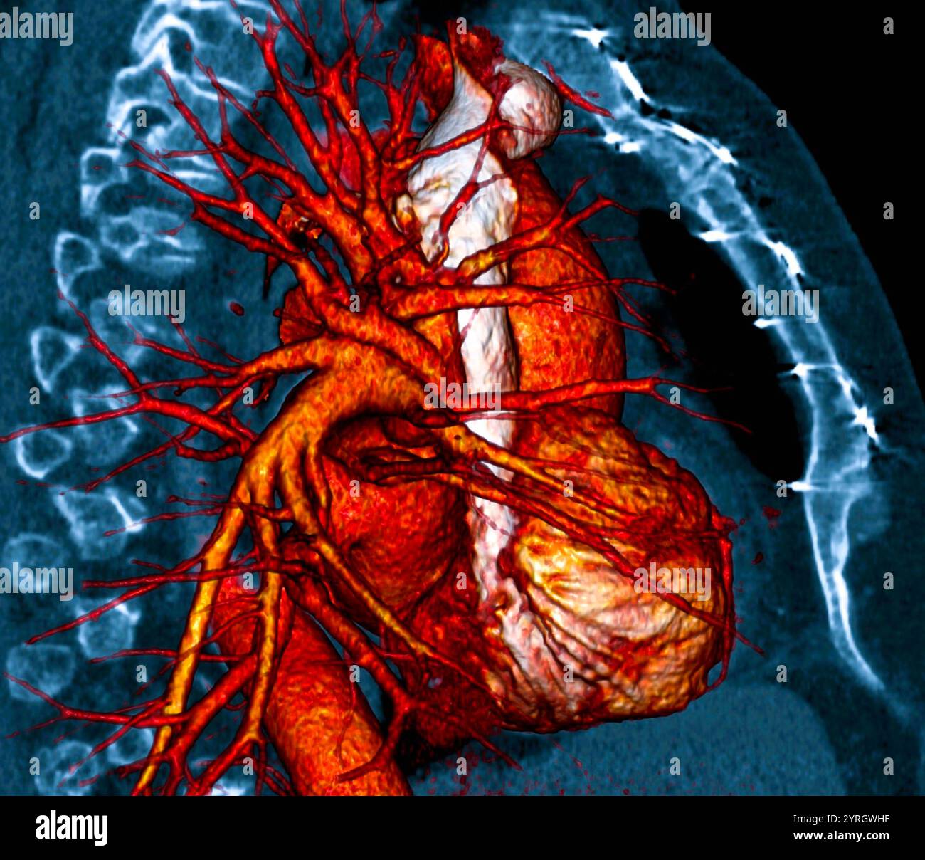 Coloured 3D computed tomography (CT) angiogram scan of the heart reveals atherosclerosis ...