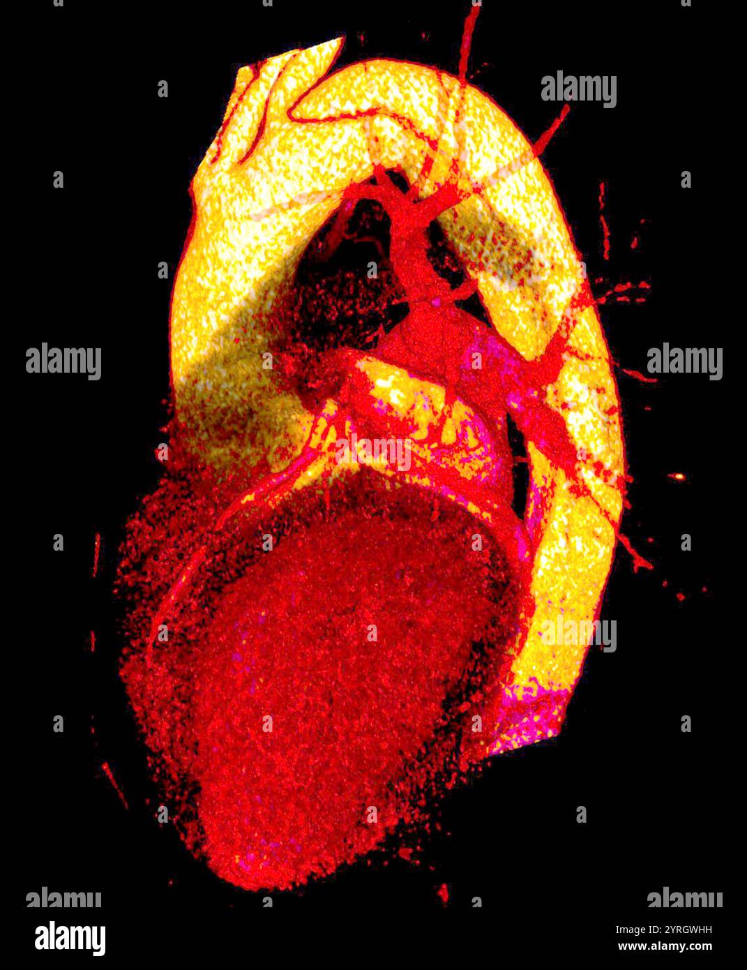 Coloured 3D computed tomography (CT) scan of a heart with an aortic dissection. The aorta is the ...
