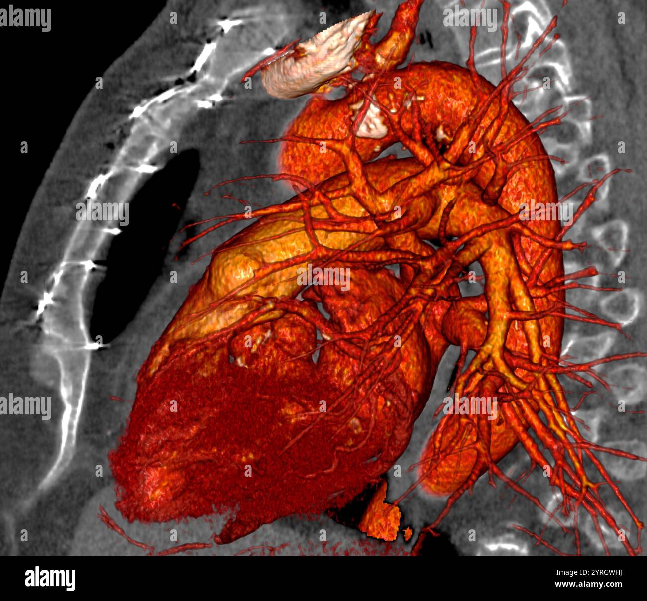 Coloured 3D computed tomography (CT) angiogram scan of the heart ...