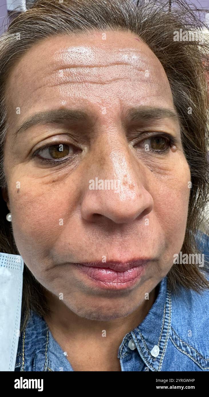 Ashy dermatosis on the face of a female patient. This condition, also ...