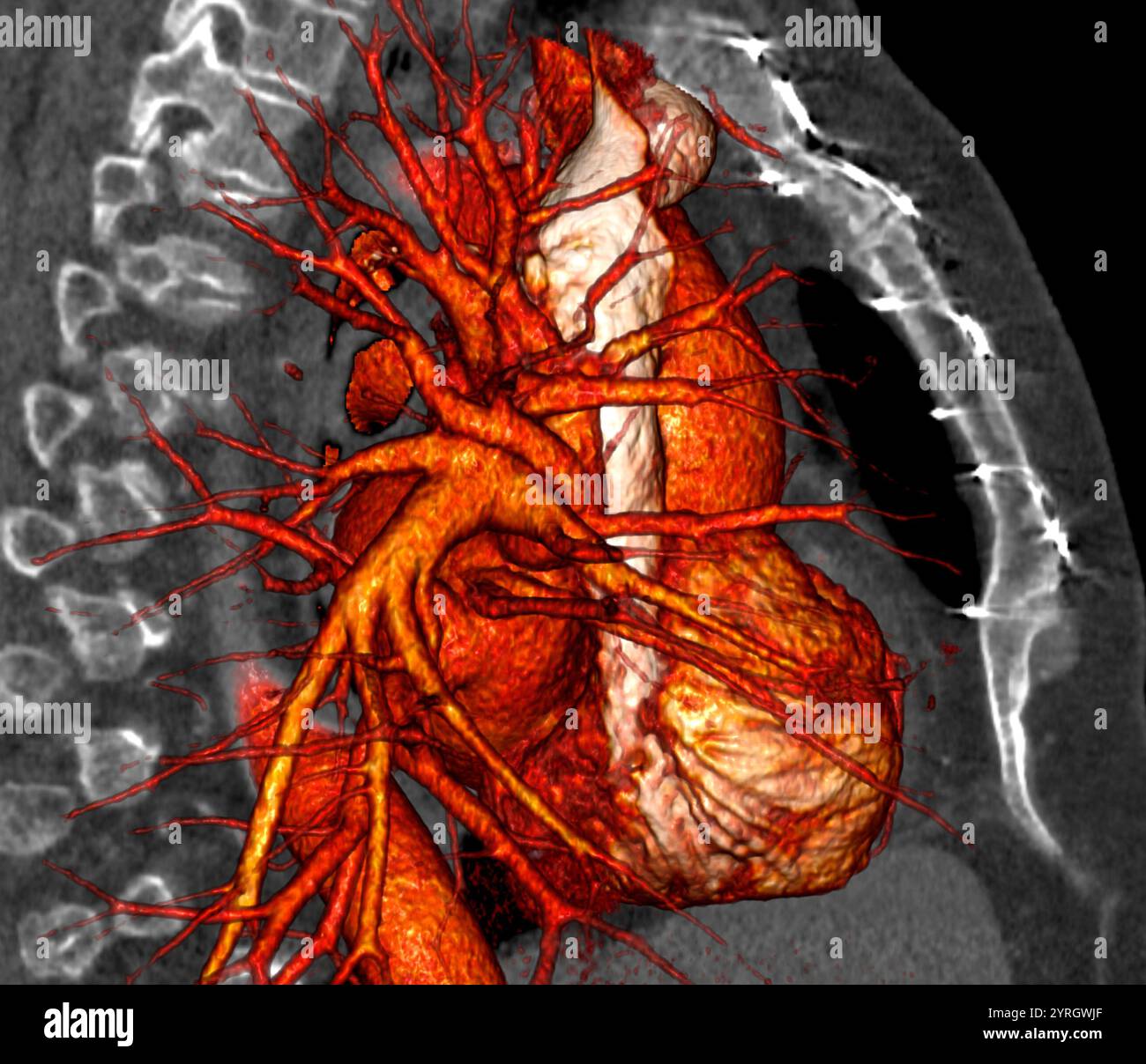 Coloured 3D computed tomography (CT) angiogram scan of the heart reveals atherosclerosis ...