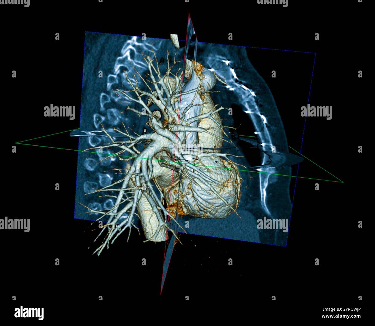 Coloured 3D computed tomography (CT) angiogram scan of the heart reveals atherosclerosis ...