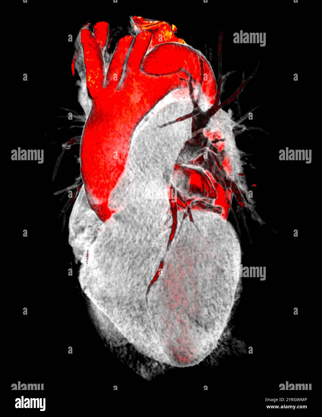 Coloured 3D computed tomography (CT) scan of a heart with an aortic dissection. The aorta is the ...