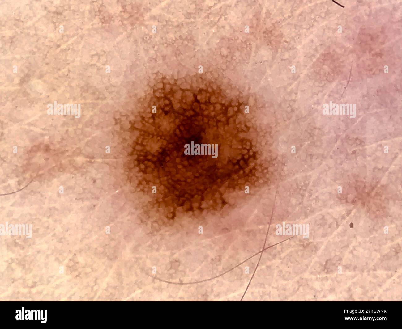 Dermatoscope image of a reticular, or acquired, naevus on a patient's ...
