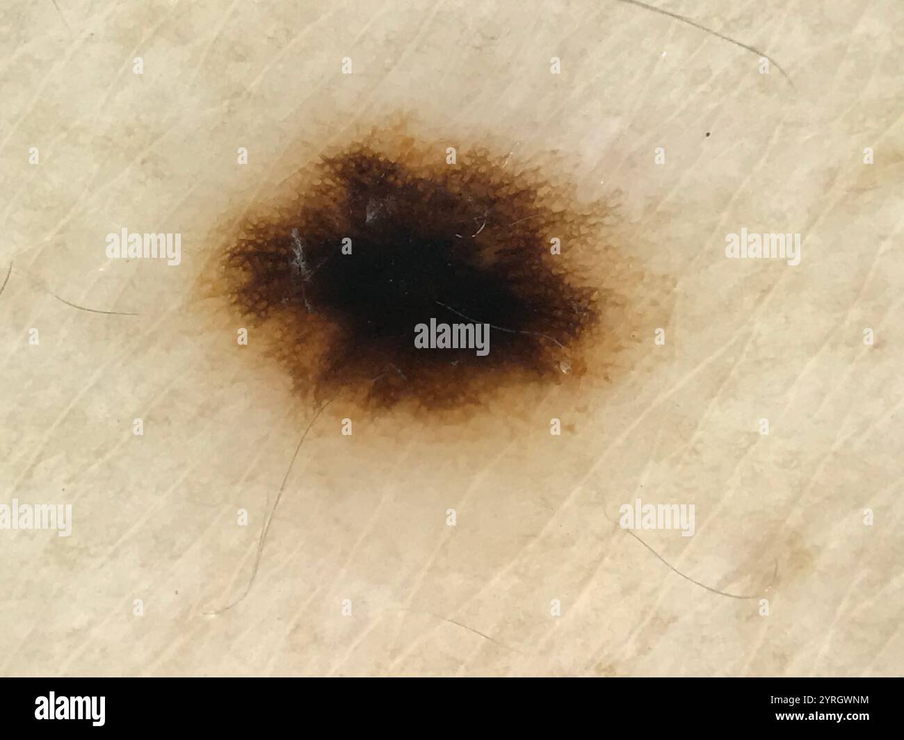 Dermatoscope image of a reticular, or acquired, naevus on a patient's ...