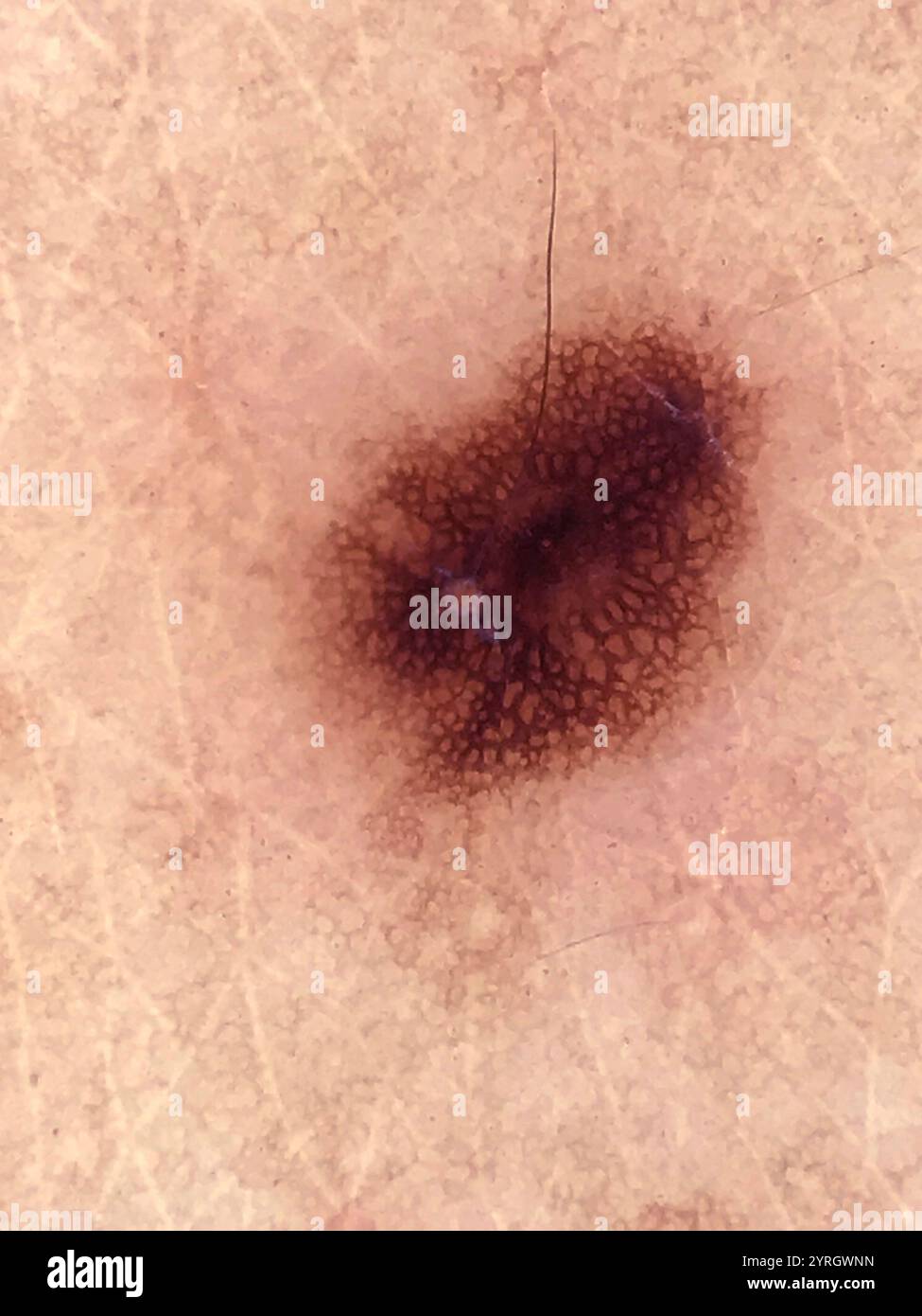 Dermatoscope image of a reticular, or acquired, naevus on a patient's ...