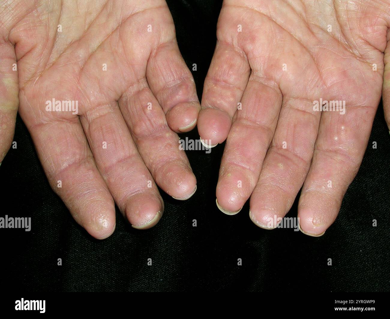 Calcinosis and scleroderma affecting a patient's hands. Scleroderma ...