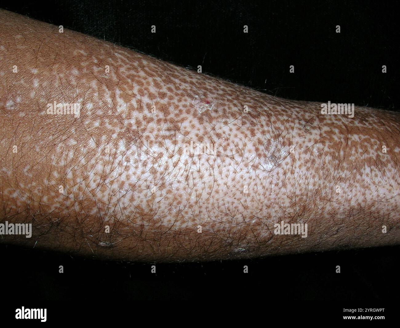 Skin of a 49 year old Hispanic female patient with scleroderma showing ...