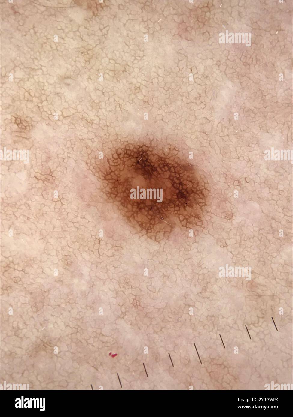 Dermatoscope image of a reticular, or acquired, naevus on a patient's ...