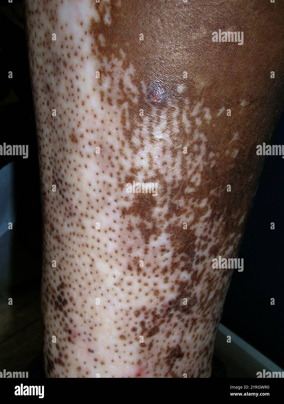 Skin of a 49 year old Hispanic female patient with scleroderma showing ...