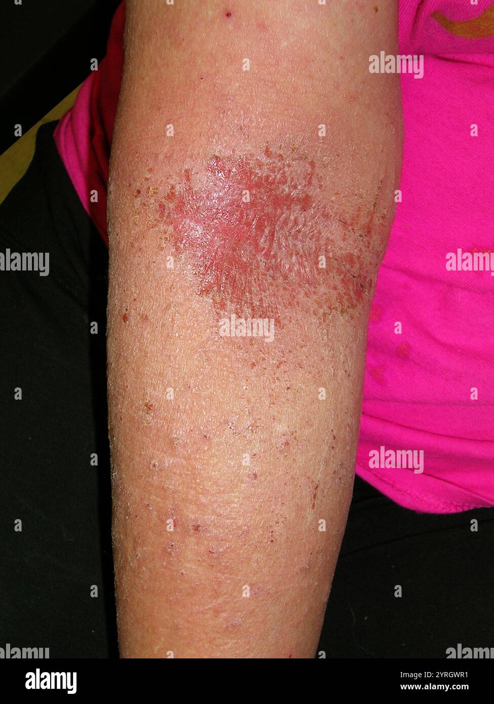 Pustules on the inner elbow of a patient with infected atopic ...