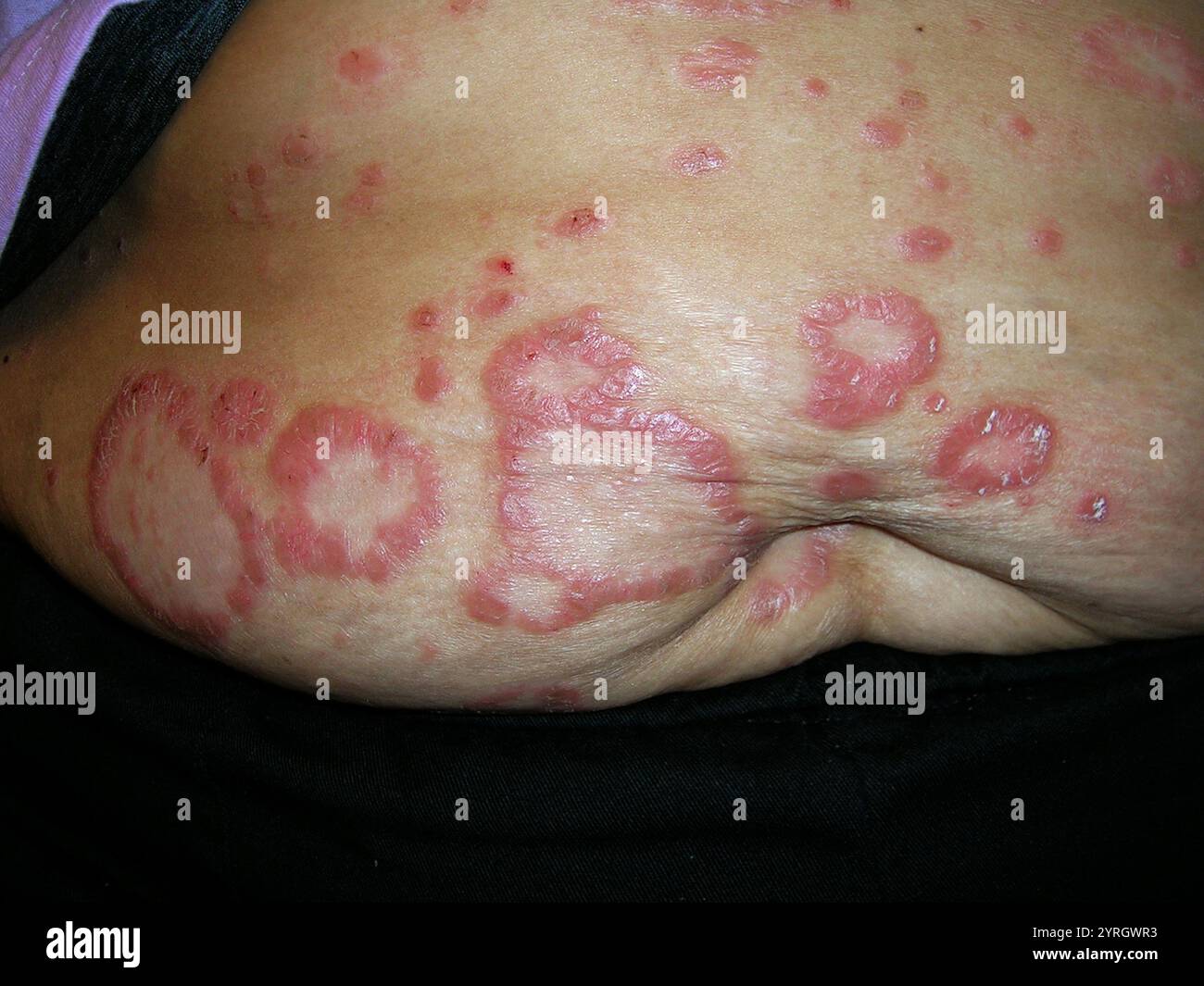 Annular psoriasis on a female Hispanic patient's abdomen. Psoriasis is ...