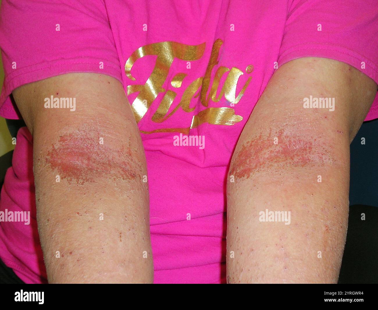 Pustules on the inner elbows of a patient with infected atopic ...