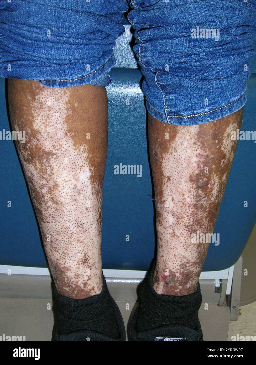 Skin on the legs of a 49 year old Hispanic female patient with ...