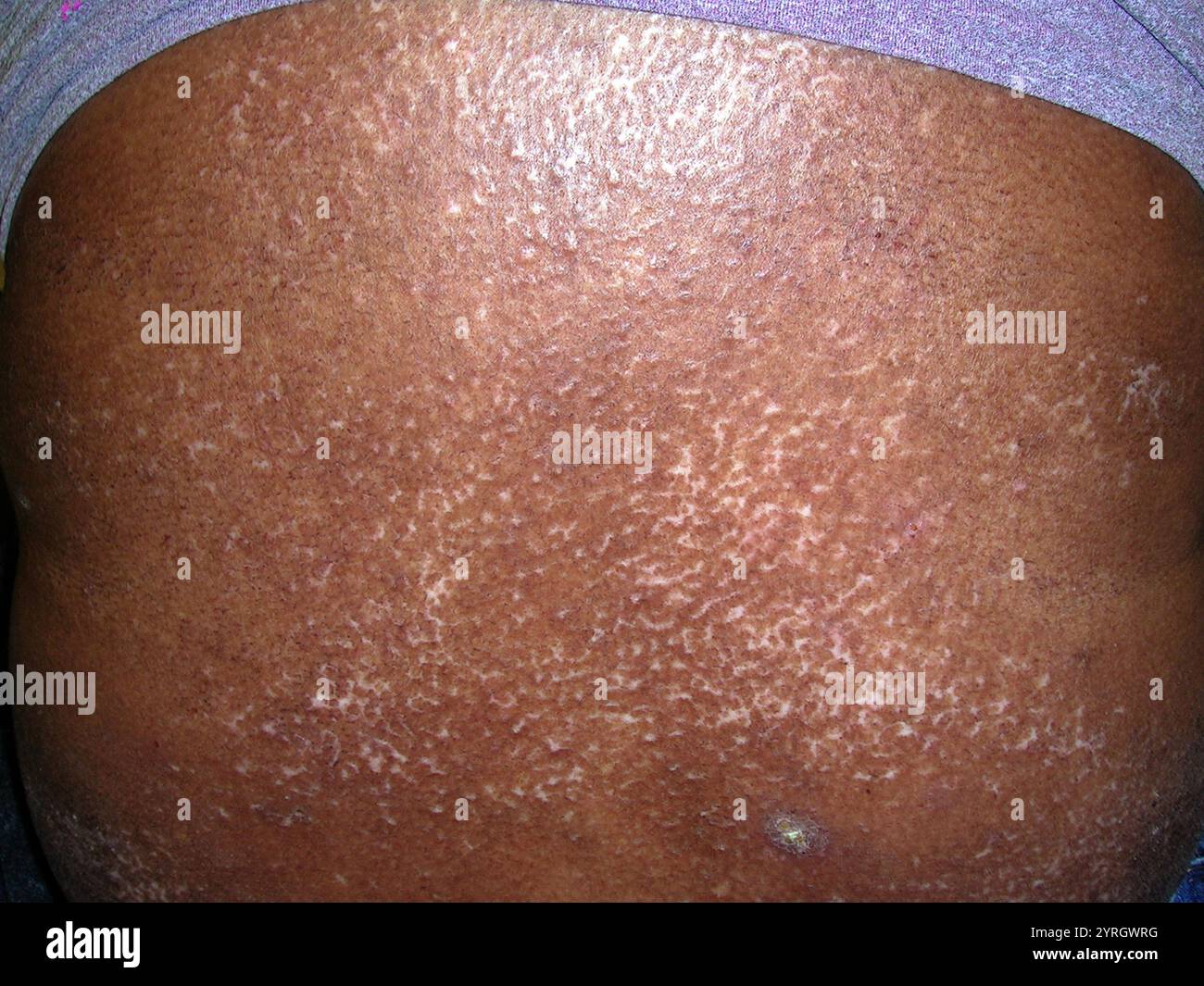 Skin on the back of a 49 year old Hispanic female patient with ...