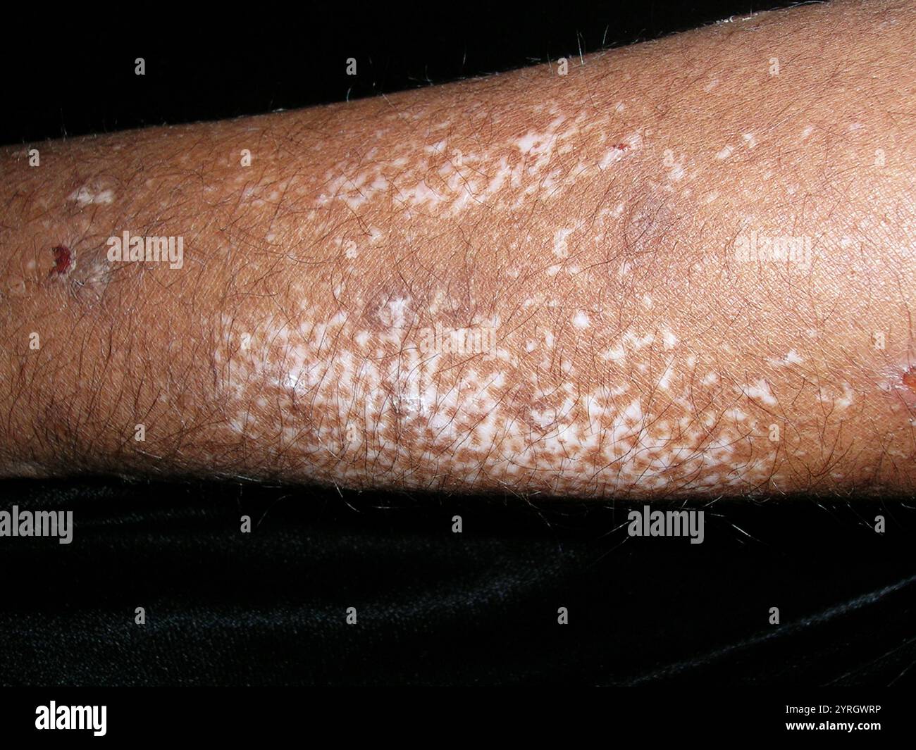 Skin of a 49 year old Hispanic female patient with scleroderma showing ...