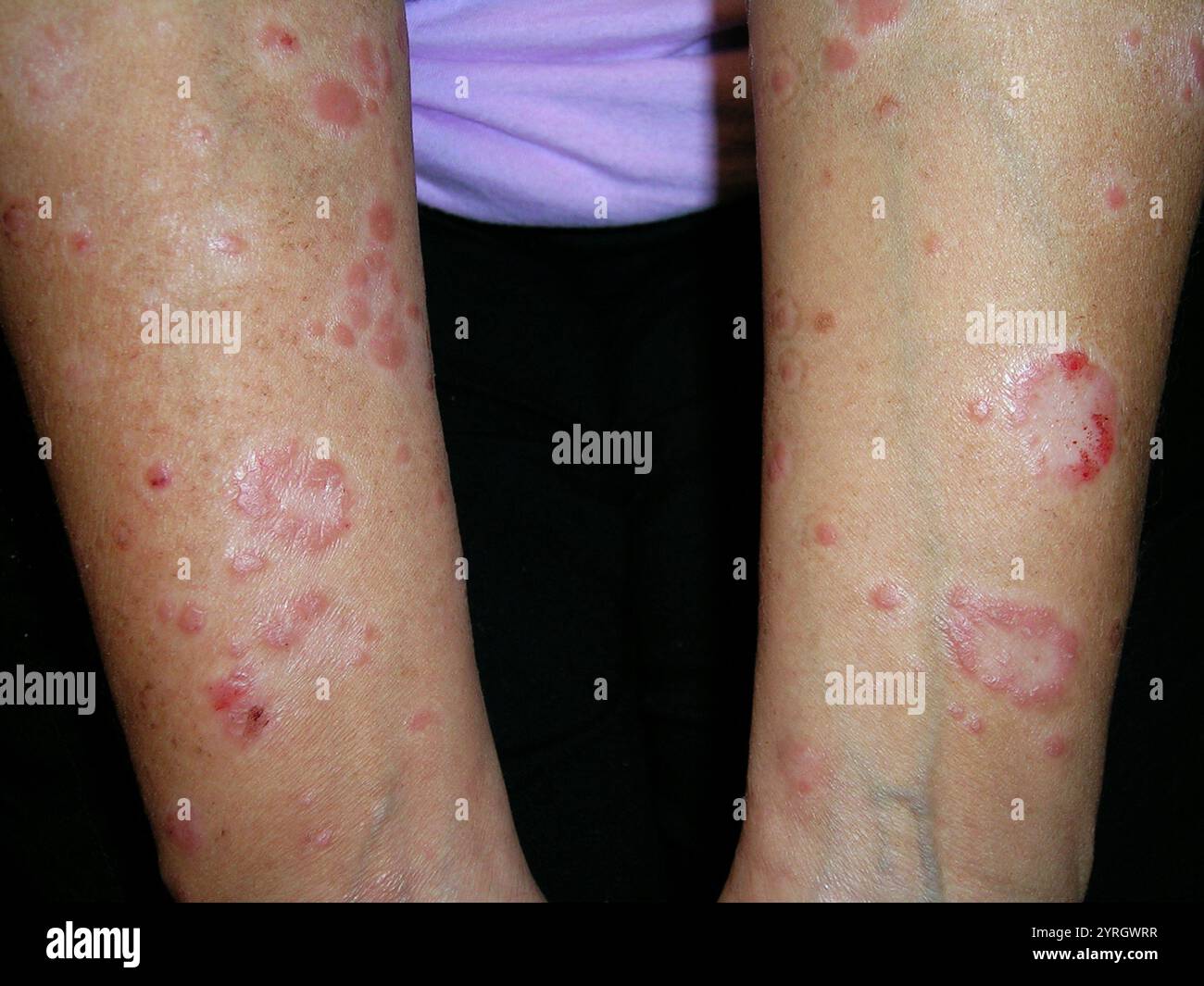 Annular psoriasis on a female Hispanic patient's arms. Psoriasis is a ...