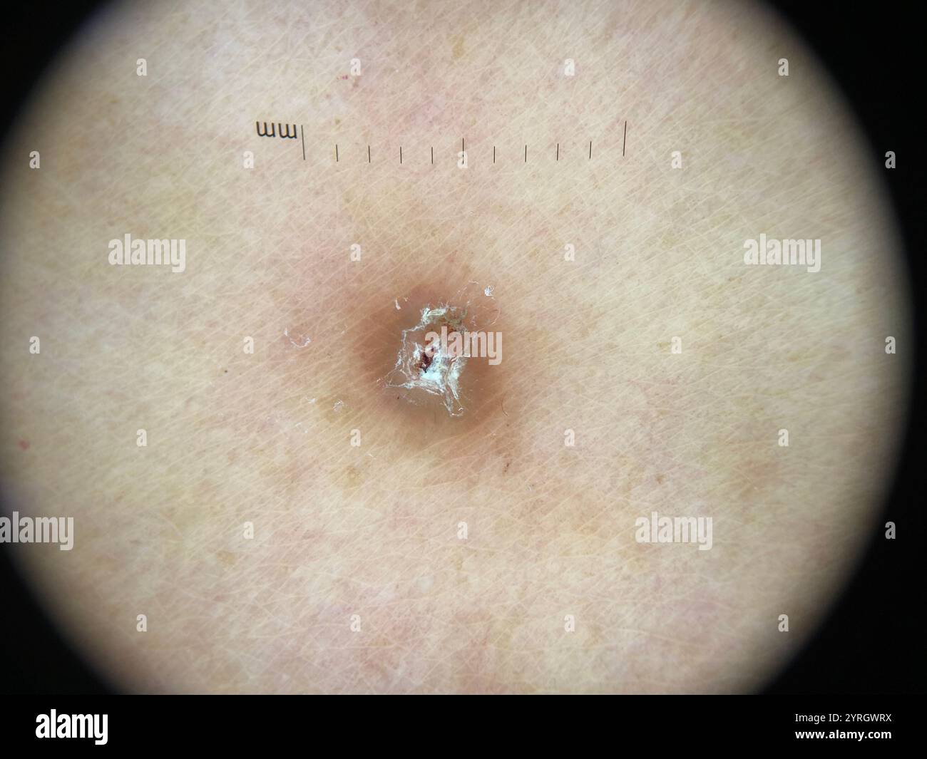 Perforating dermatosis, dermoscopy Stock Photo - Alamy
