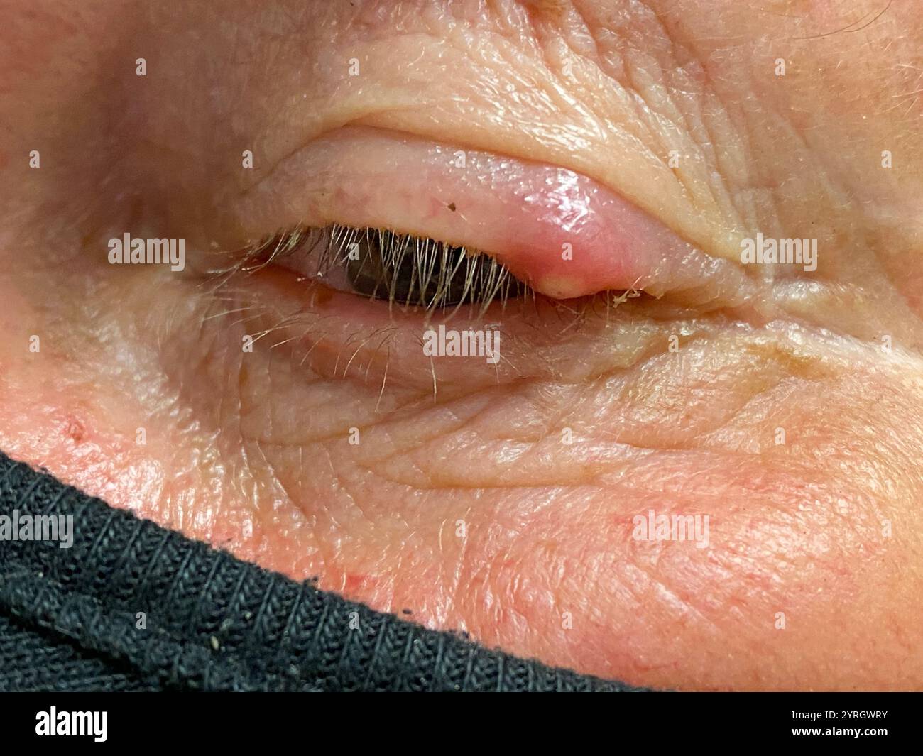 Stye on a patient's eyelid. A stye, or hordeolum, is a bacterial ...
