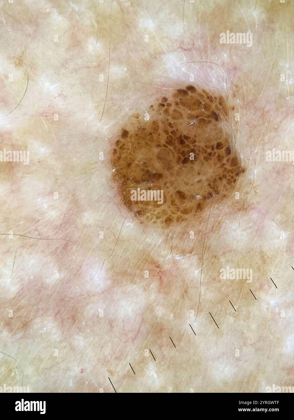 Dermatoscope image of globules (round to oval structures) in a ...