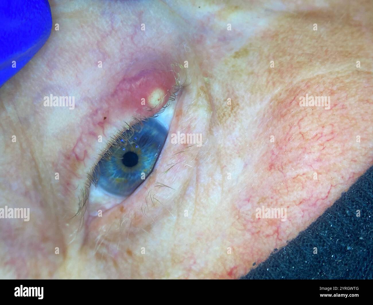 Stye on a patient's eyelid. A stye, or hordeolum, is a bacterial ...