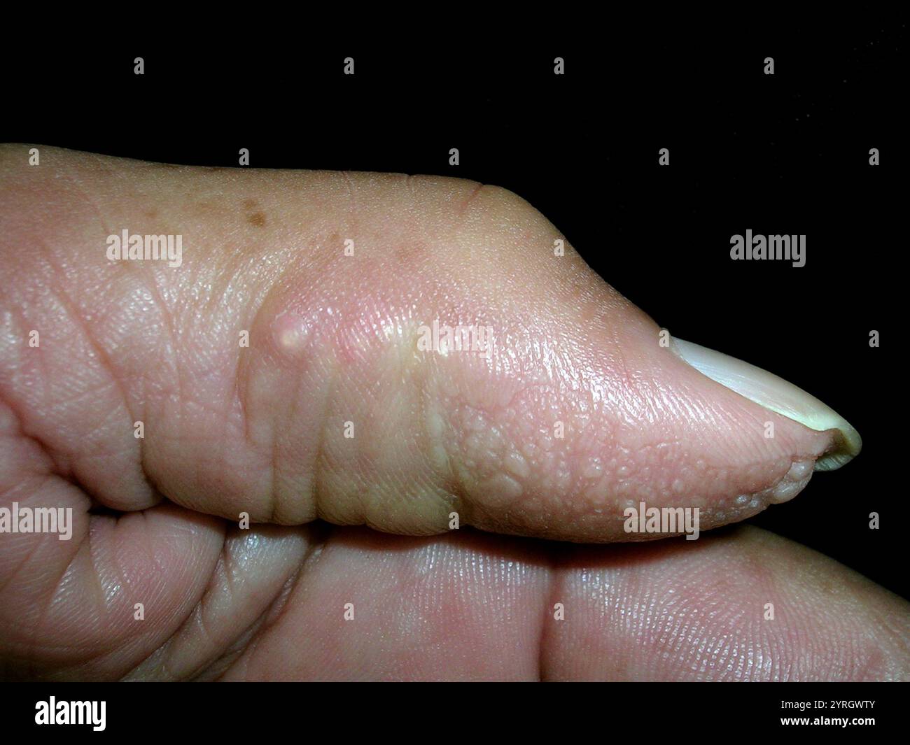 Calcinosis and scleroderma affecting the hand of a 64 year old white ...