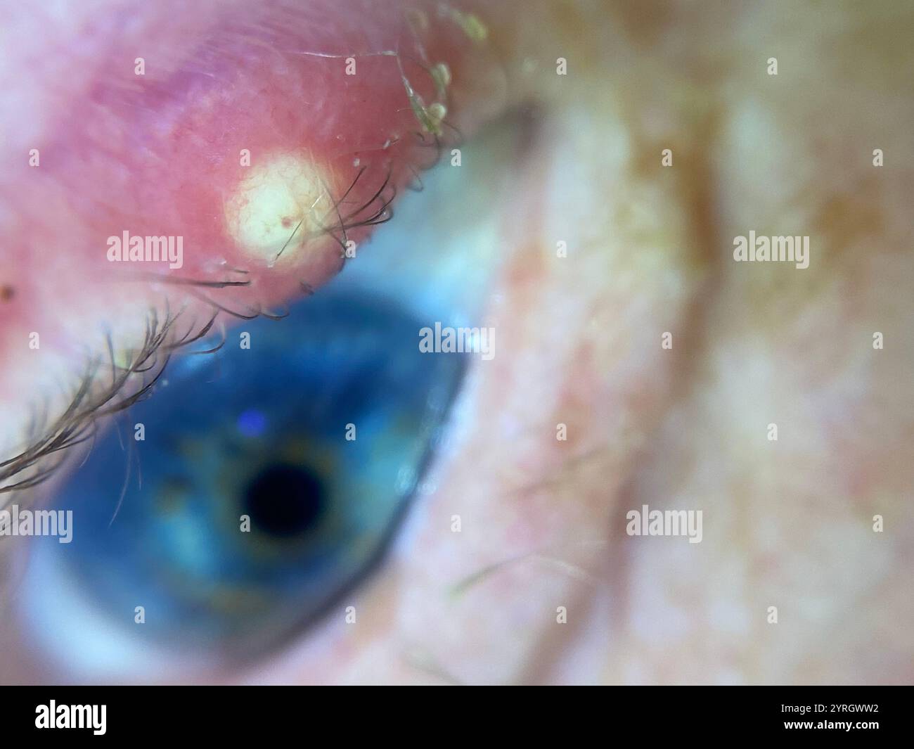 Stye on a patient's eyelid. A stye, or hordeolum, is a bacterial ...