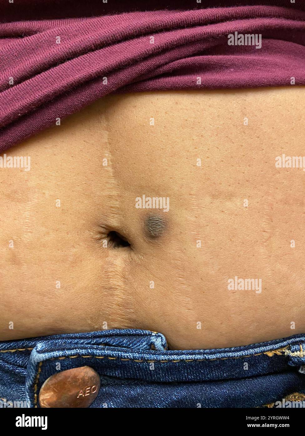 Epidermoid cyst on a 39 year old African American female patient's ...