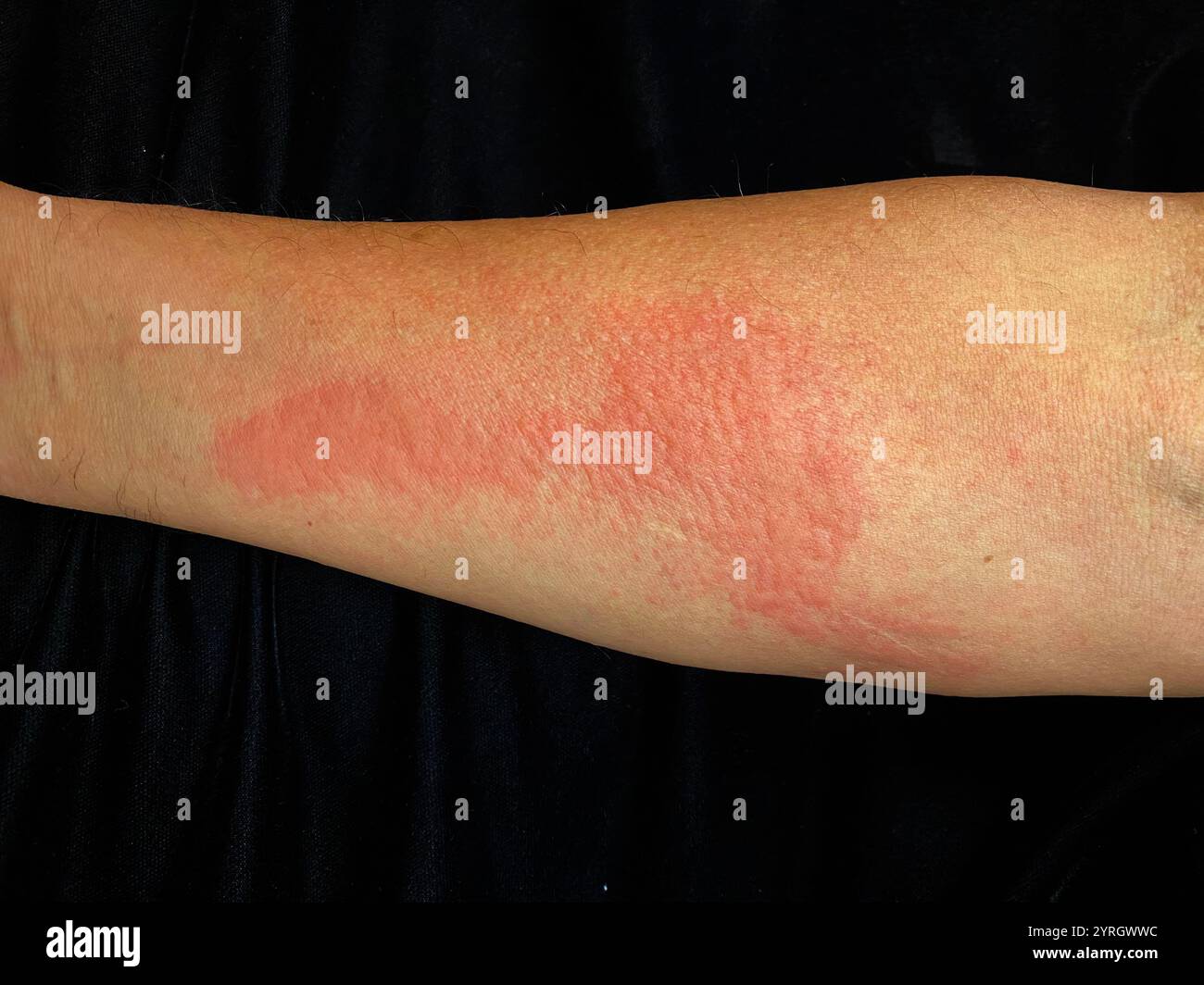 Pressure urticaria on the arm of a Hispanic male patient. Pressure ...